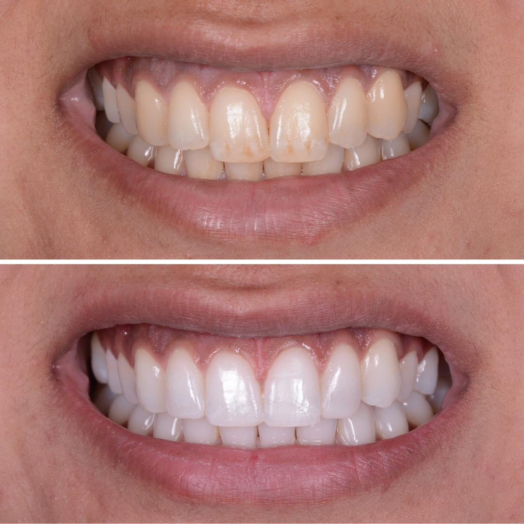 Enlighten Teeth Whitening Solutions - London - Enlighten Smiles