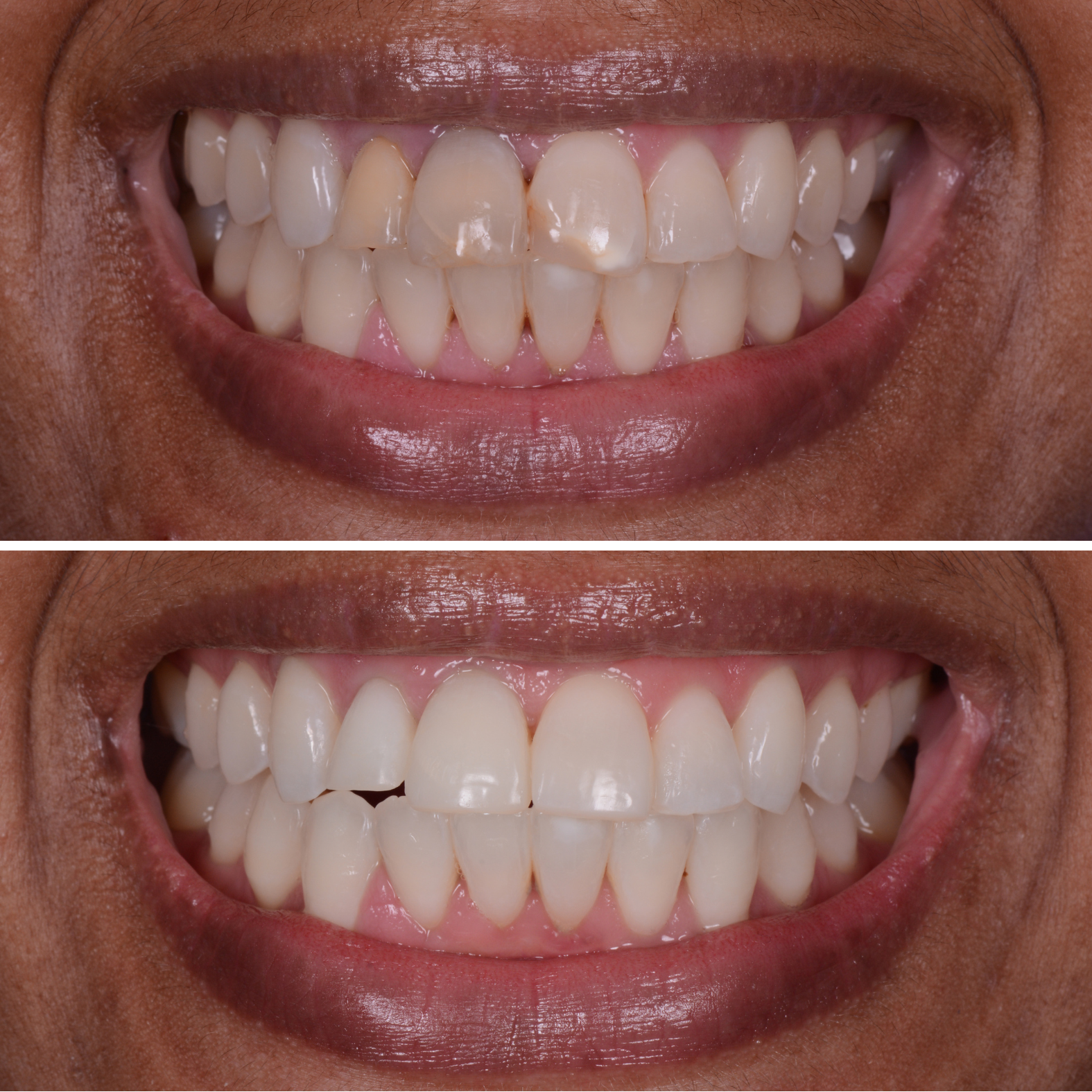 Enlighten Teeth Whitening Solutions - London - Enlighten Smiles