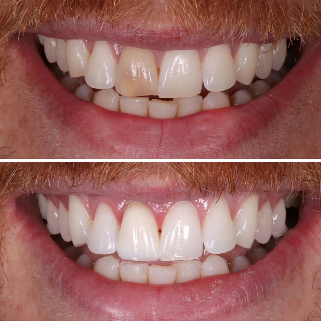 Enlighten Teeth Whitening Solutions - London - Enlighten Smiles